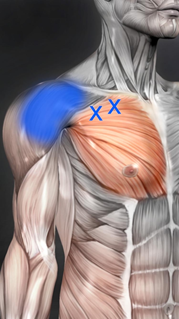 Orthopedic Massage Online Course | Trigger Point & Referral Patterns